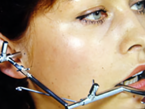 Condylator